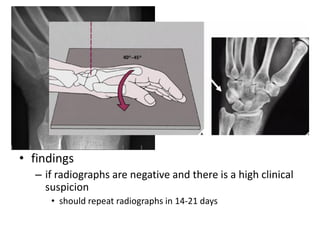 Ortho Conference Scaphoid Fracture | PPT
