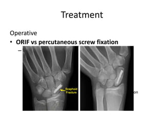 Ortho Conference Scaphoid Fracture | PPT