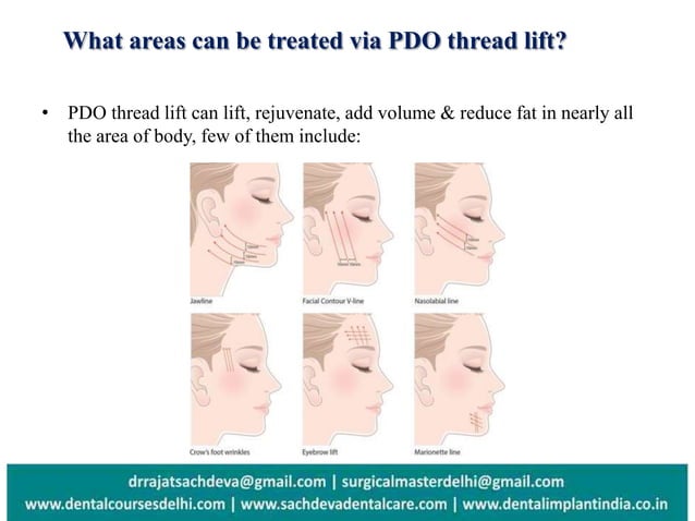 PDO Thread Lift