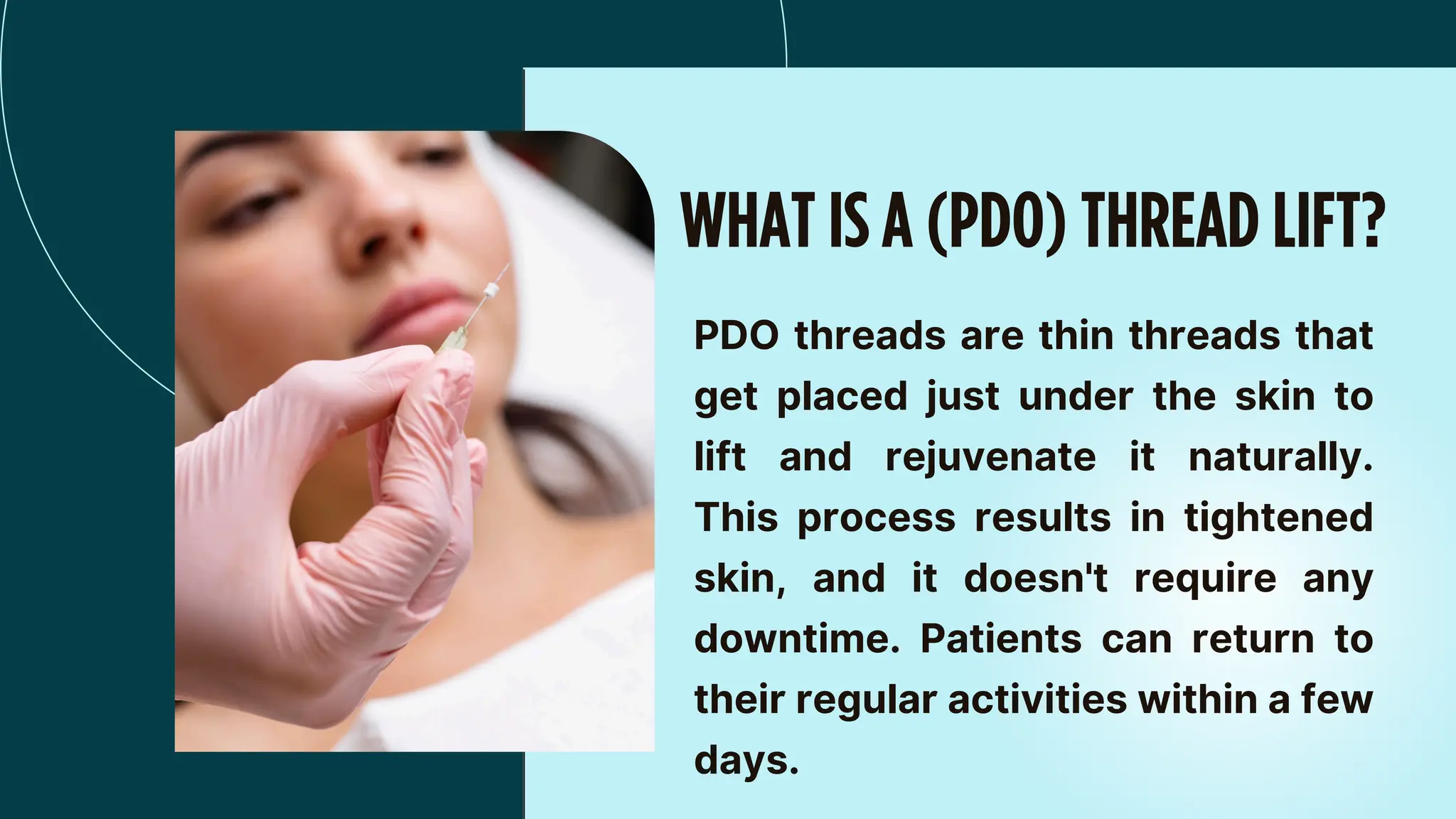 PDO Thread Lifting: The Best Solution for a Youthful Appearance! | PDF ...