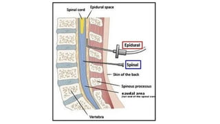 Post dural puncture headache by Dr.Megha Sharma | PPTX