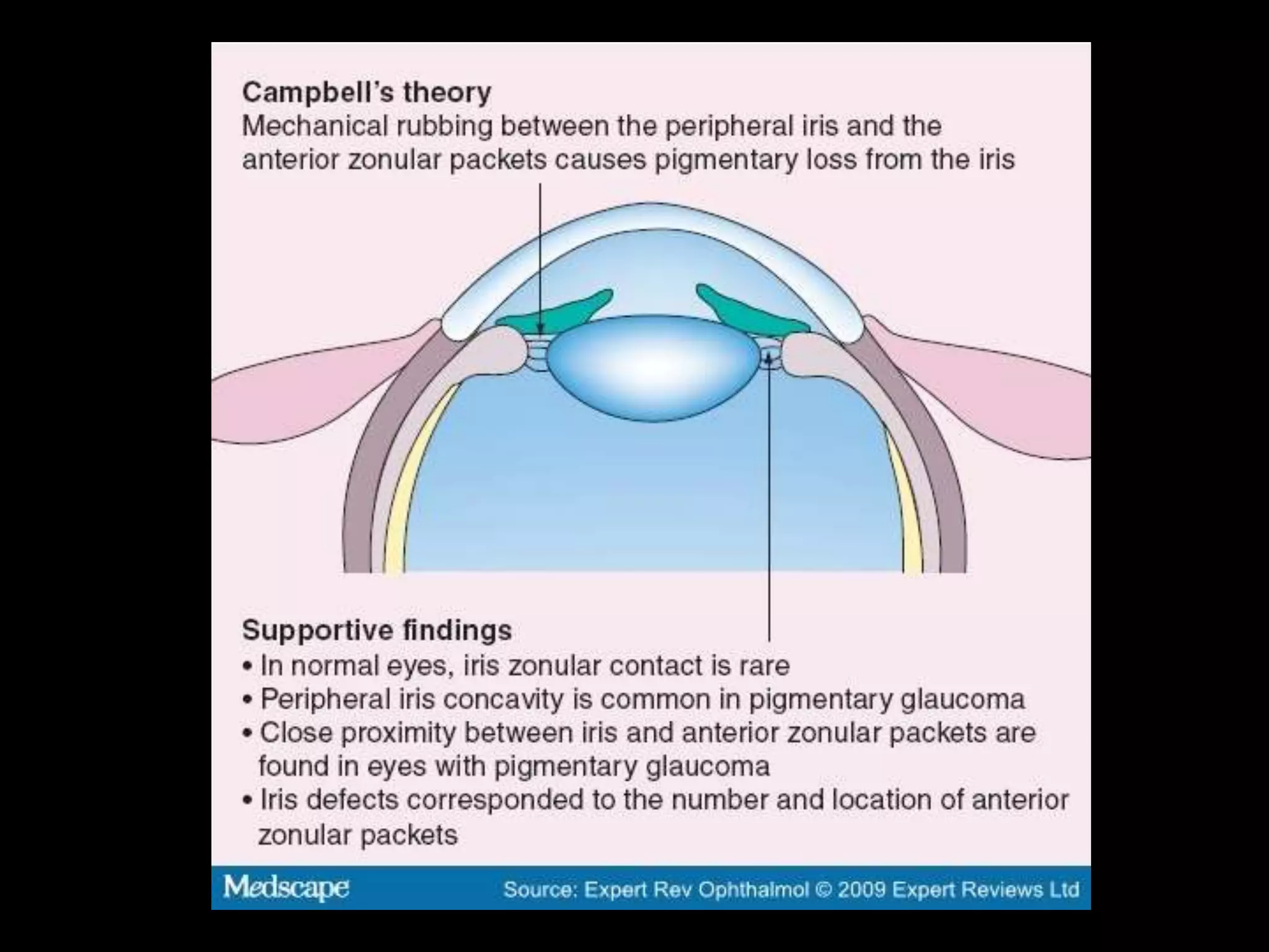 Pigment Dispersion Syndrome & Pigmentary Glaucoma | PPTX