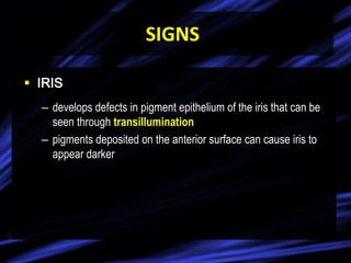 Pigment Dispersion Syndrome & Pigmentary Glaucoma | PPTX
