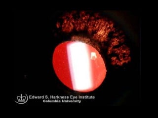 Pigment Dispersion Syndrome & Pigmentary Glaucoma | PPTX