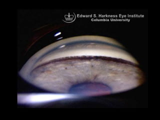 Pigment Dispersion Syndrome & Pigmentary Glaucoma | PPTX