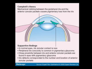 Pigment Dispersion Syndrome & Pigmentary Glaucoma | PPTX