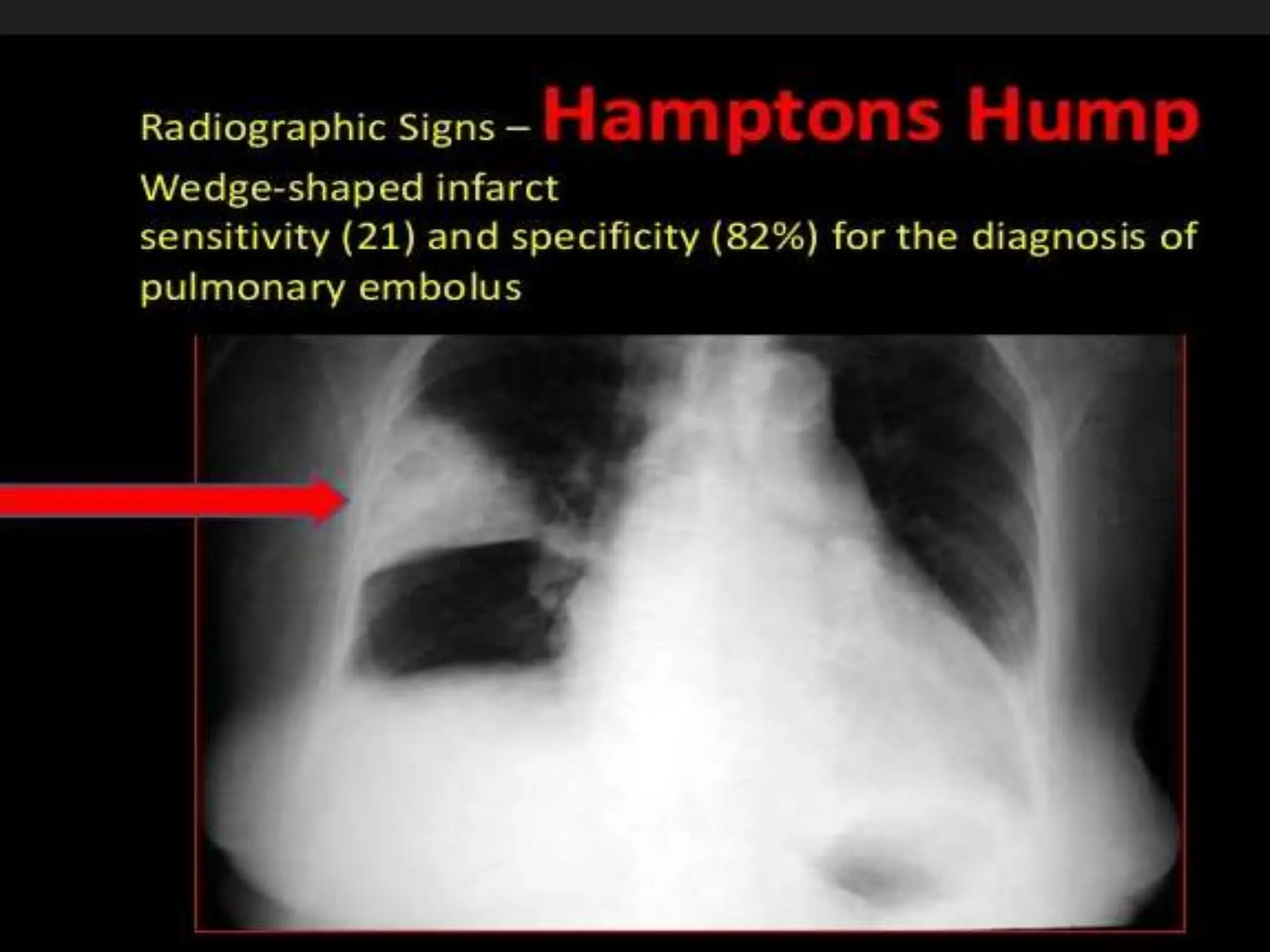 pe.pptx pulmonary embolism diagnosis and management | PPTX