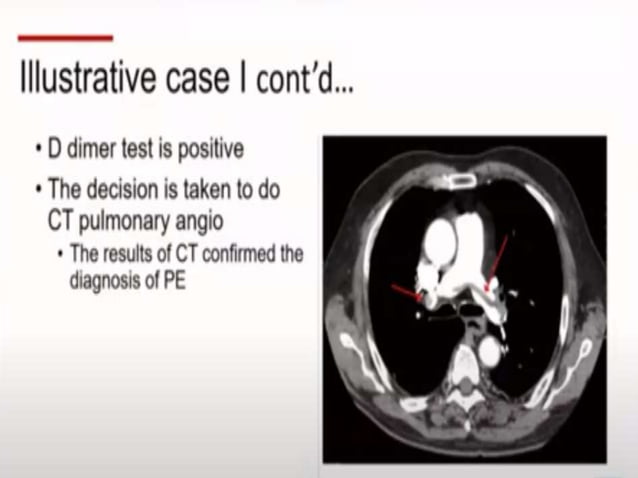 pe.pptx pulmonary embolism diagnosis and management | PPTX