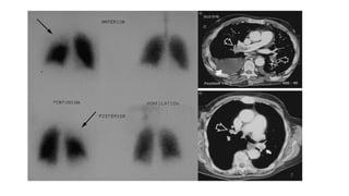 Pulmonary embolism ventilation perfusion scan | PPTX