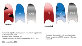 Pulmonary embolism ventilation perfusion scan | PPTX