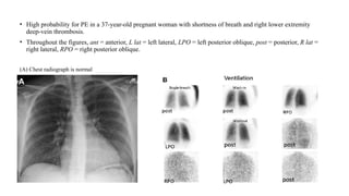 Pulmonary embolism ventilation perfusion scan | PPTX