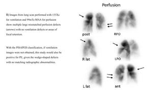 Pulmonary embolism ventilation perfusion scan | PPTX