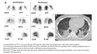 Pulmonary embolism ventilation perfusion scan | PPTX
