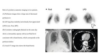 Pulmonary embolism ventilation perfusion scan | PPTX