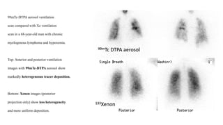 Pulmonary embolism ventilation perfusion scan | PPTX
