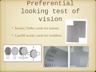 Peadiatric eye assessment | PPT