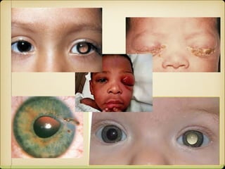 Peadiatric eye assessment | PPT