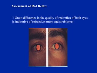 Peadiatric Eye Conditions | PPT