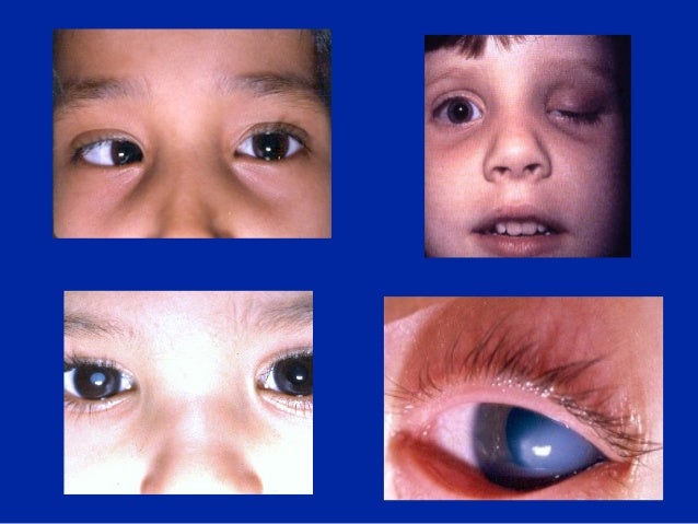 Peadiatric Eye Conditions