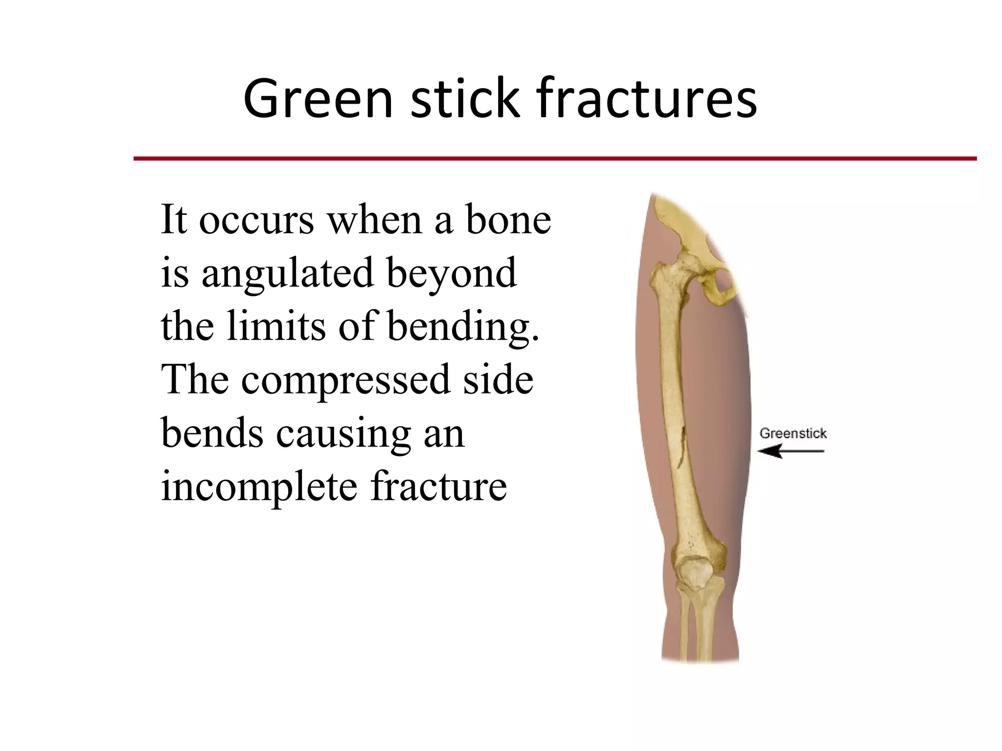 Peads fractures | PPT
