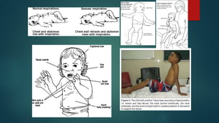 respiratory failure and shock definition and management | PPTX
