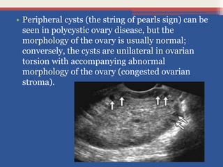 Pearls and pitfalls presentation in ovarian torsion | PPT