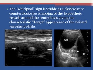 Pearls and pitfalls presentation in ovarian torsion | PPTX