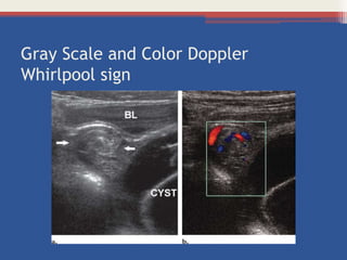 Pearls and pitfalls presentation in ovarian torsion | PPTX | Thyroid ...