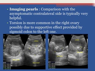 Pearls and pitfalls presentation in ovarian torsion | PPTX