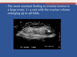 Pearls and pitfalls presentation in ovarian torsion | PPTX