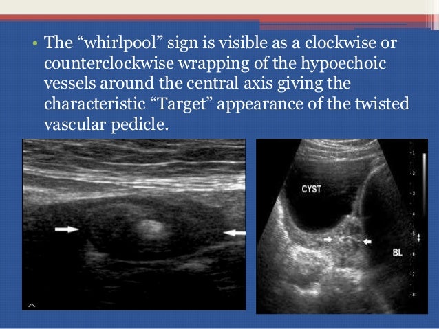 Pearls and pitfalls presentation in ovarian torsion