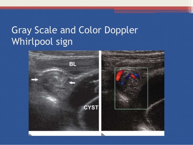 Ovarian Torsion Ultrasound Whirlpool Sign Incomplete Ovarian Torsion
