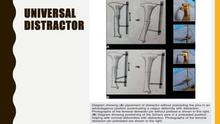 Pearls and pitfalls with im nailing of proximal tibia fractures | PPTX