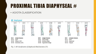Pearls and pitfalls with im nailing of proximal tibia fractures | PPTX