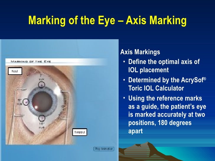 Pearls for Acrysof Toric IOL in Practice Dr Suresh K Pandey, kota, in…