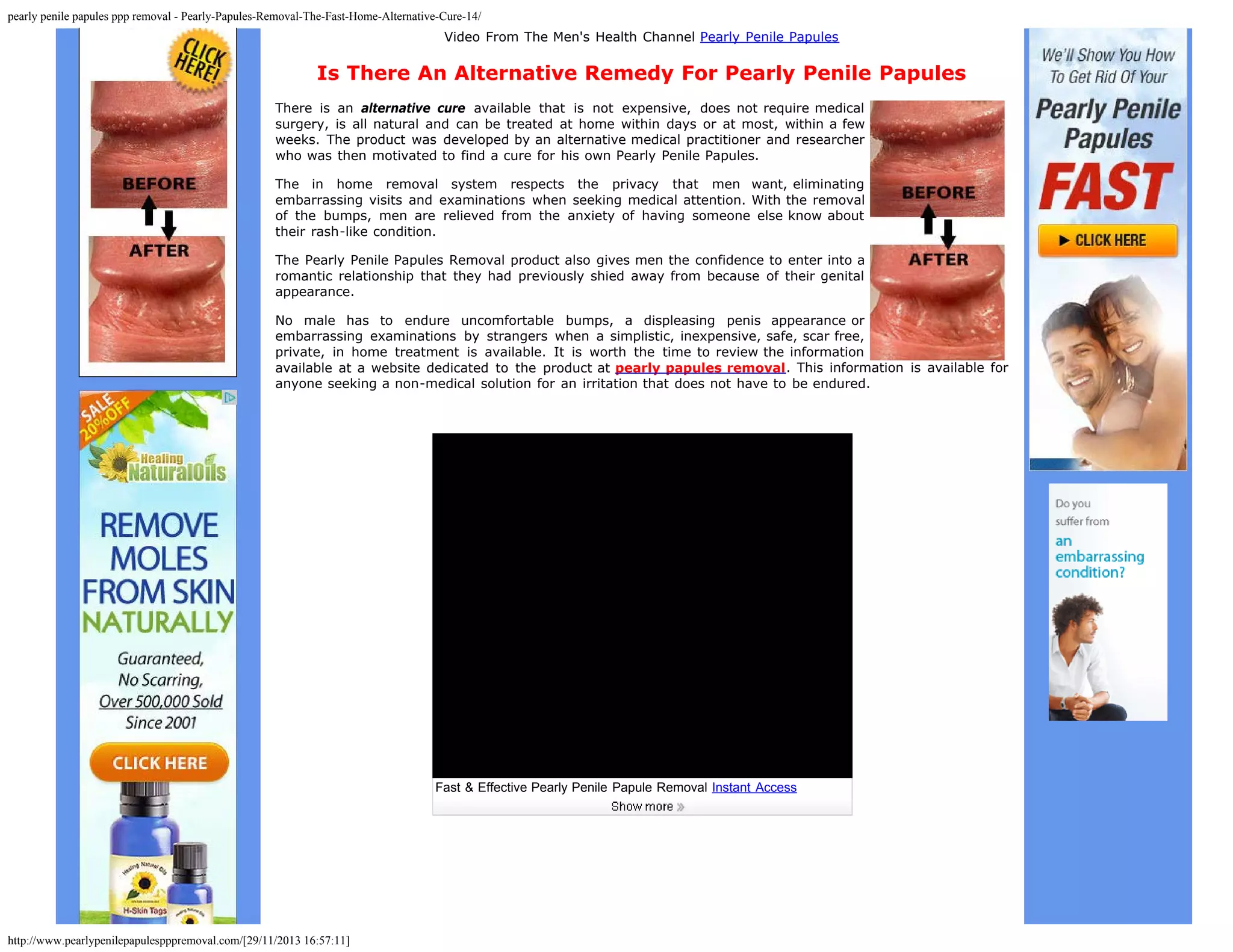 pearly papules removal the fast home alternative cure | PDF