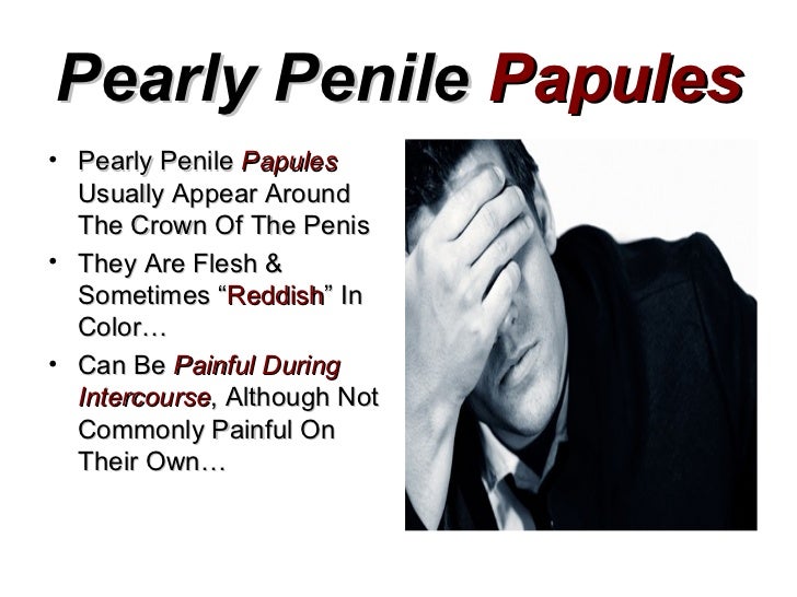Pearly Penile Papules|Pearly Penile Papule Removal