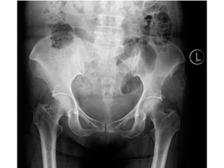 Pearr osteosarcoma | PPT