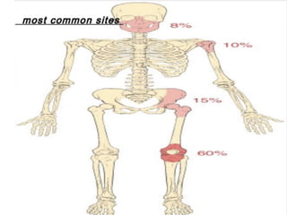 Pearr osteosarcoma | PPT