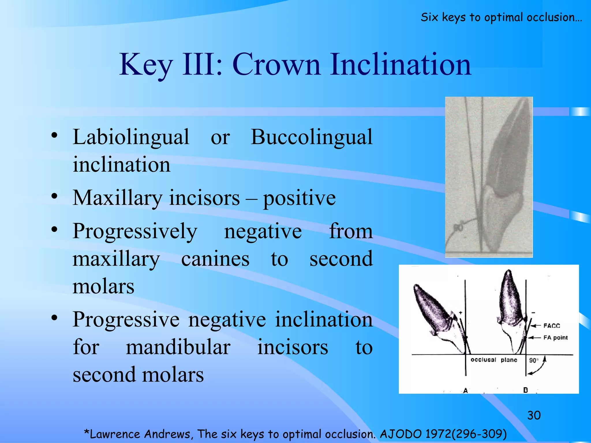 preadjusted edgewise appliance | PPT