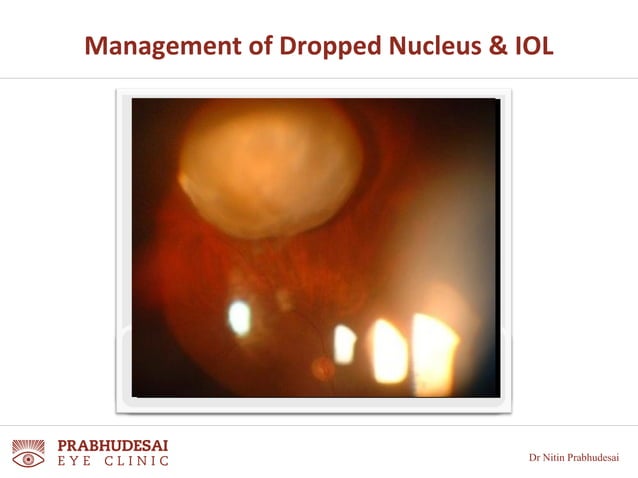 Management of Dropped Nucleus and IOL | PPT