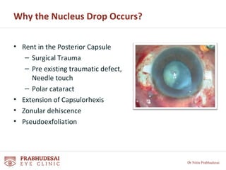 Management of Dropped Nucleus and IOL | PPT