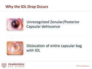 Management of Dropped Nucleus and IOL | PPT