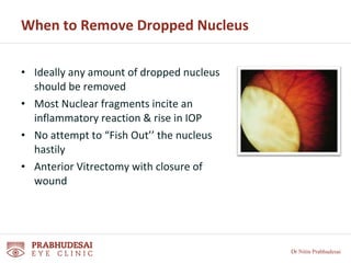Management of Dropped Nucleus and IOL | PPT