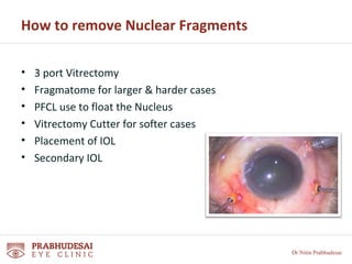 Management of Dropped Nucleus and IOL | PPT