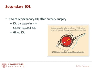 Management of Dropped Nucleus and IOL | PPT