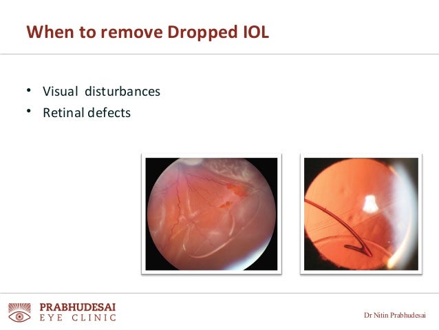 Management of Dropped Nucleus and IOL