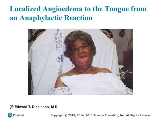 Pec11 chap 21 anaphylactic reactions | PPT