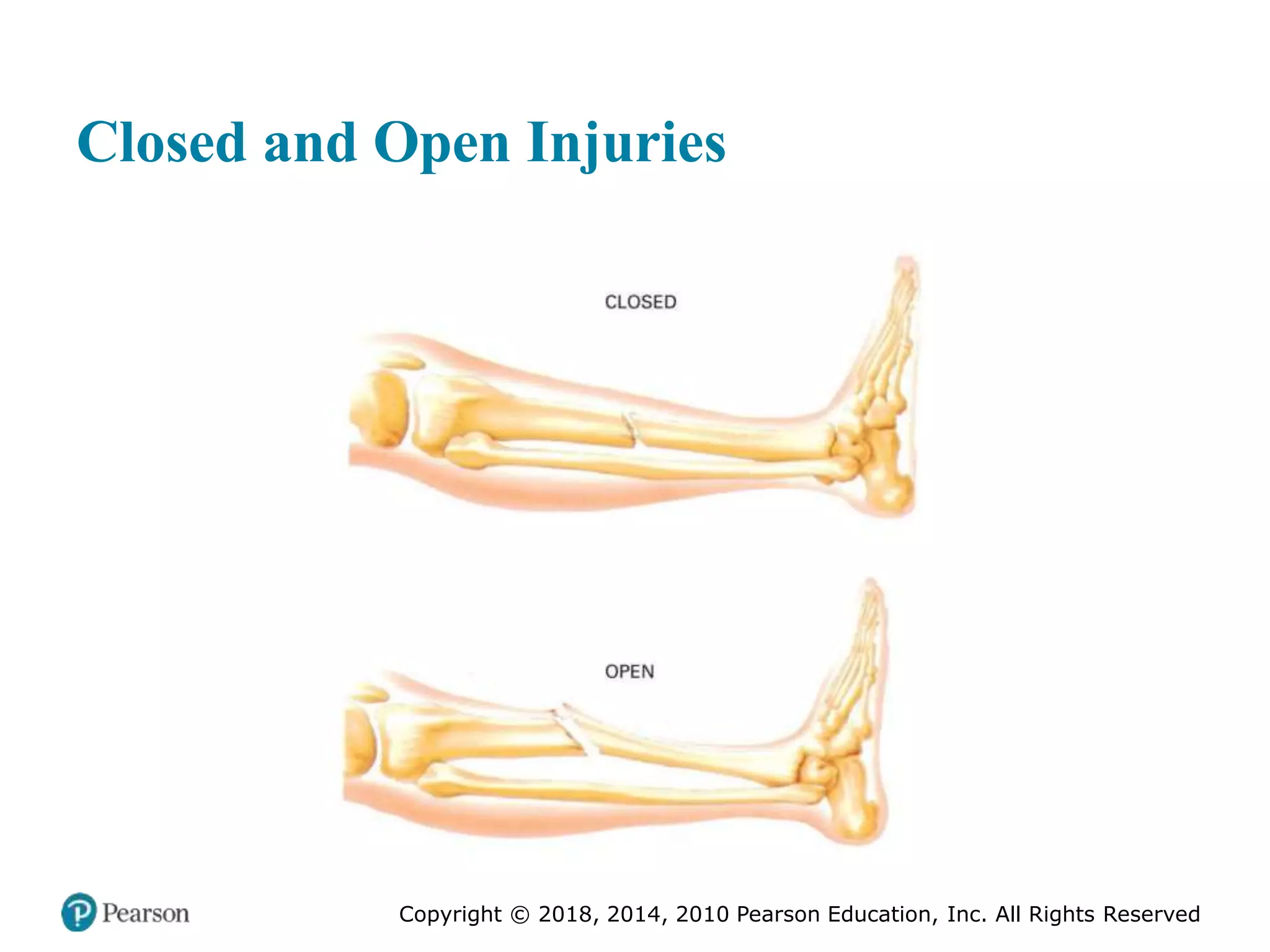 Pec11 chap 30 musculoskeletal trauma | PPTX