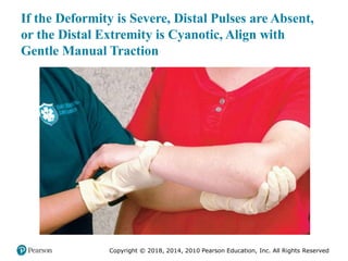 Distal Pulses